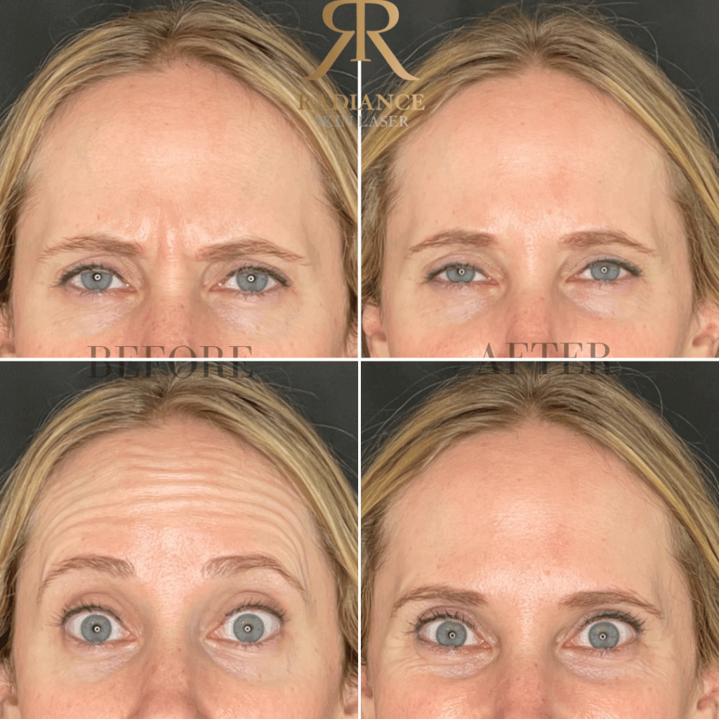 Forehead Treatment Before and After Images | Bothell, WA