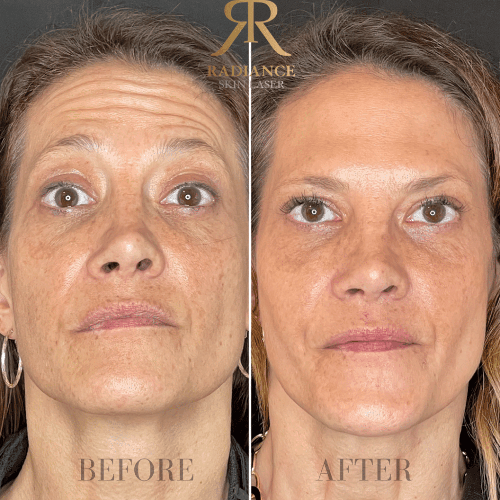 Forehead Treatment Before and After Images | Bothell, WA